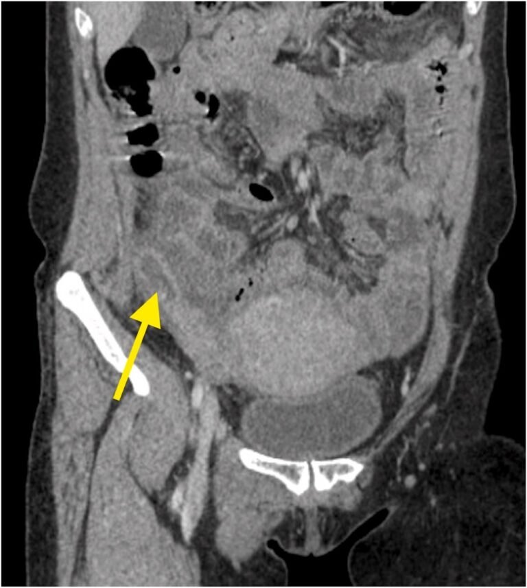 Recurrent appendicitis of vermiform appendix after a prior appendectomy ...